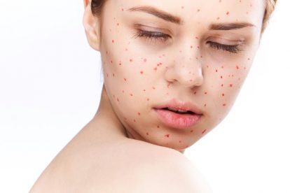 Causes of Small Red Dots on Skin and Treatment - Charlies Magazines