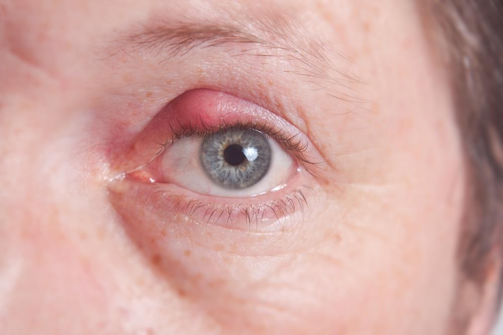 8 Natural Ways of Treatment of Pimple on Eyelid - Charlies Magazines