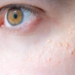 Blue Waffle Disease – Everything You Need to Know About