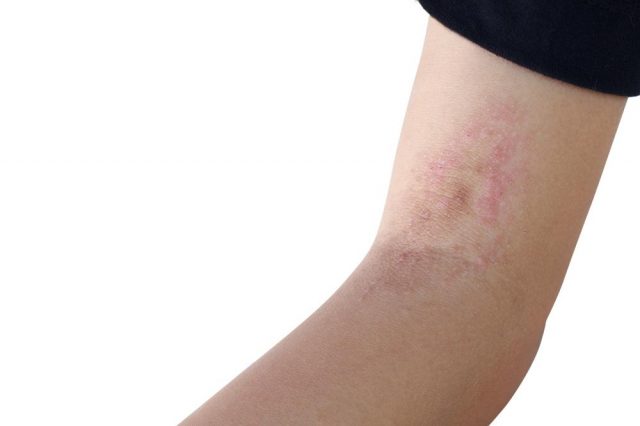 7 Natural and Effective Ways to Get Rid of Ringworm Infection ...